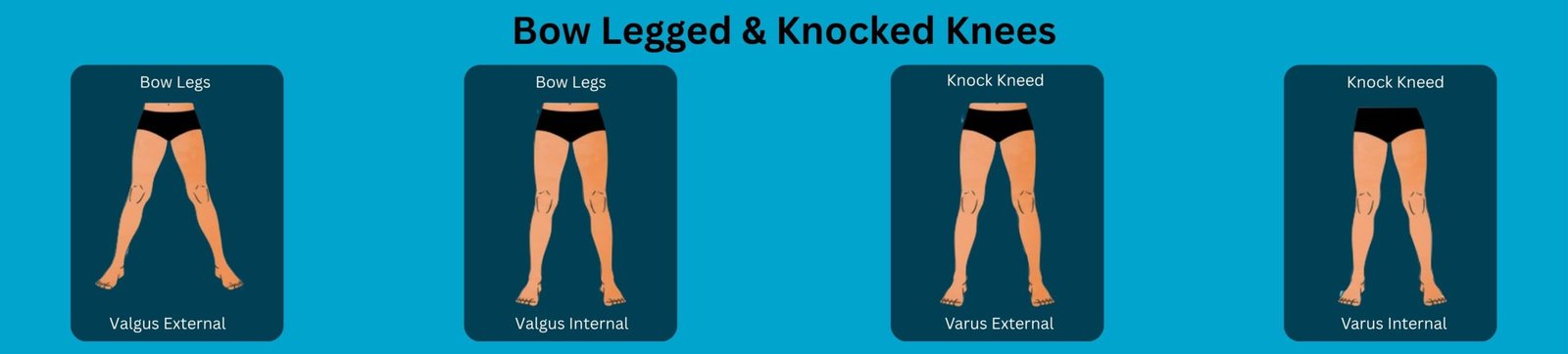 Get treatment on Bow Legged & Knocked Knees -Dr.Nawaid Ahmed - Dr ...